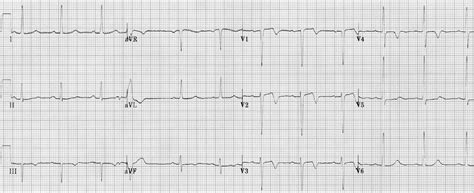 Ecg Litfl Diagnosis Sinus Ekg Ventricular Bifascicular Myocardial