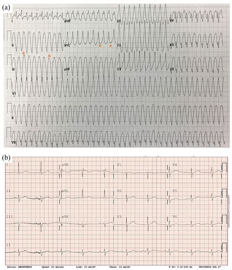 Sustained Monomorphic Ventricular Tachycardia As The Presenting Sign Of