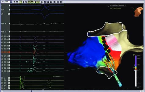 Inferior Left Anterior Oblique Views Of The Right Atrium With