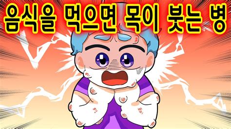 음식을 먹으면 목이 붓는 병 꼬냥썰 실화 썰툰 Youtube