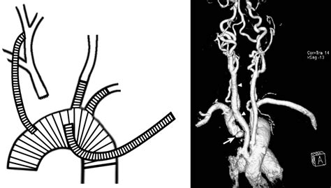 Perfusion And Repair Technique In Acute Aortic Dissection With Cerebral