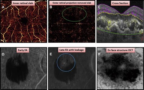 Sensitivity And Specificity Of Oct Angiography To Detect Choroidal Neovascularization