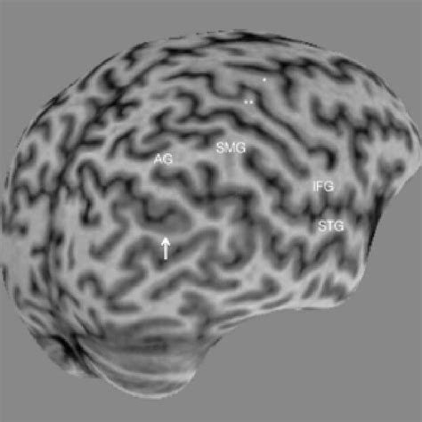 Curvilinear Reconstruction Showing Right Parietal Cortical Thickness