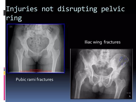 Pelvic Injuries Trauma 2012 Pptx