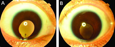 Anterior Segment Photography Showed Coloboma Of The Iris Presenting