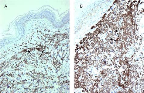 Systemic Elastin Degradation In Chronic Obstructive Pulmonary Disease