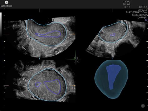 Ultrasound Fibroids Diagnostic Advancement With Fibroid Mapping