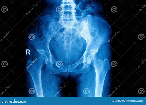 Male Vs Female Pelvis X Ray