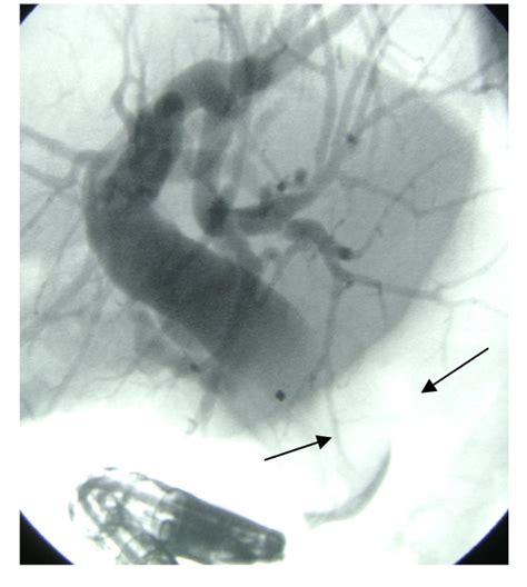 ERCP Appearance Dilated Choledochus And Unclaved Bile Duct Stone Download Scientific Diagram