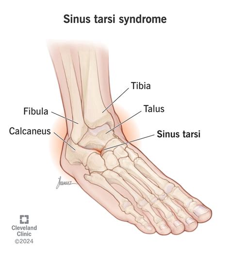 Sinus Tarsi Anatomy The Tarsal Tunnel Borders Contents