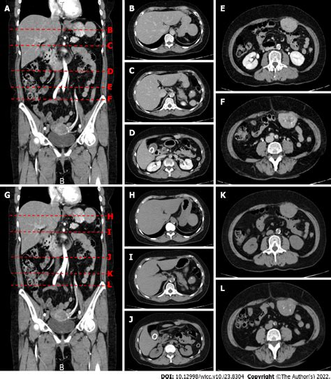 Figure 1 From Phosphoglyceride Crystal Deposition Disease Requiring