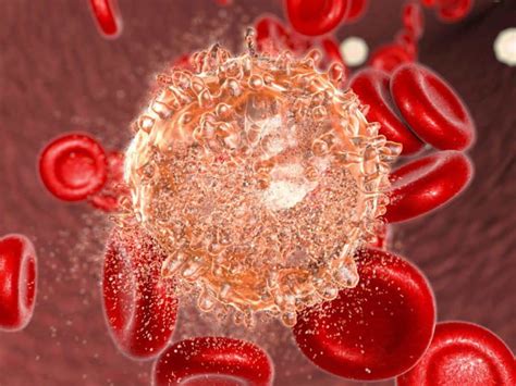 Chronic Myeloid Leukemia Cml Treatment Management And Guidelines