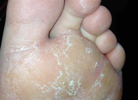 Athletes Foot On Bottom Of Feet Clidm