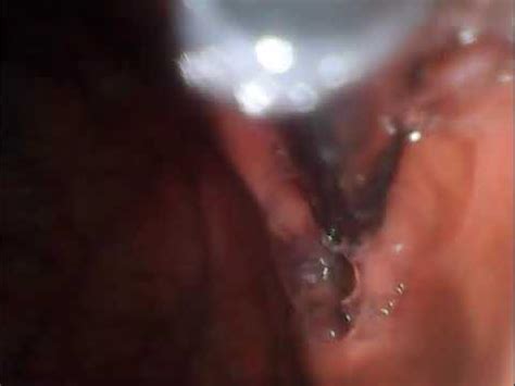 Jelly Swallow Part 2 Backward View Endoscope Pov Youtube