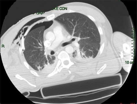 Pre Operative Ct Scan Download Scientific Diagram