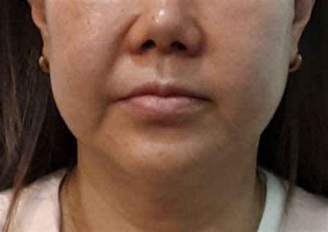 파워v얼굴지방흡입 V핏리프팅 실리프팅 후기 닥터정 리반의원