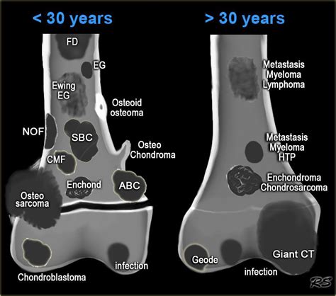 Bone Tumor Systematic Approach And Differential Diagnosis Radiology