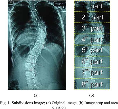 Figure From Spinal Curvature Determination From Scoliosis X Ray Image Using Sum Of Squared