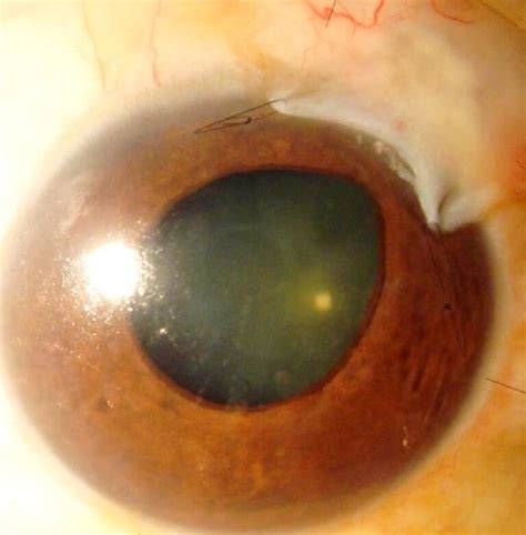 One Week After Surgery The Bleb Is Diffuse Conjuctival Vessels Have Download Scientific