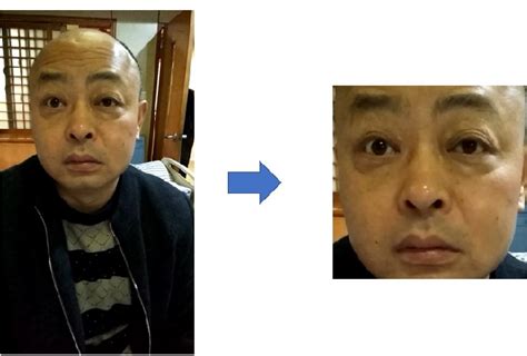 Figure 1 From Quantitative Analysis Of Facial Paralysis Based On Tcm Acupuncture Point