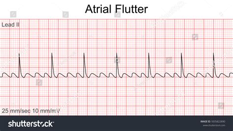 Ecg Atrial Flutter Nursing School Survival Paramedic