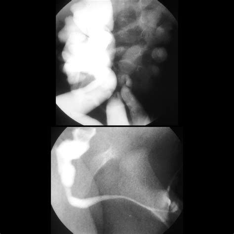 Posterior Urethral Valves Pediatric Radiology Reference Article Pediatric Imaging Pedsimaging
