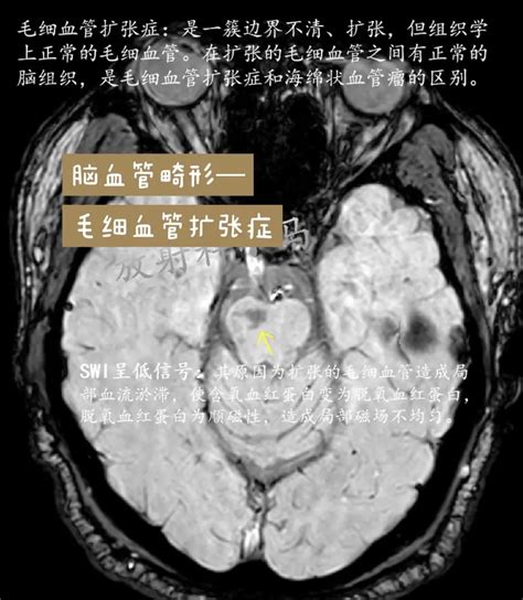 毛细血管扩张症影像学表现
