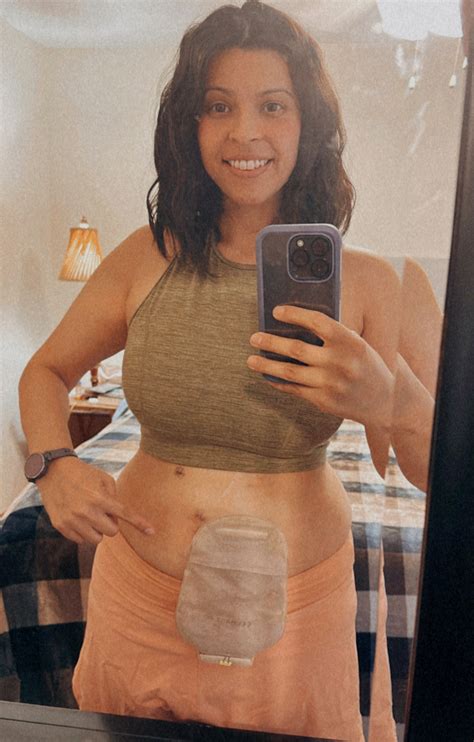 Patient Stories Archives United Ostomy Associations Of America