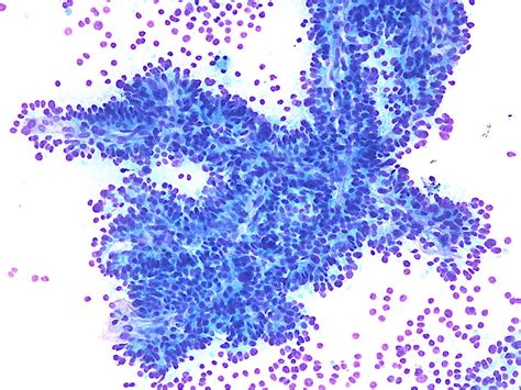 Thyroid Fna Saudi Society Of Cytotechnology And Histotechnology