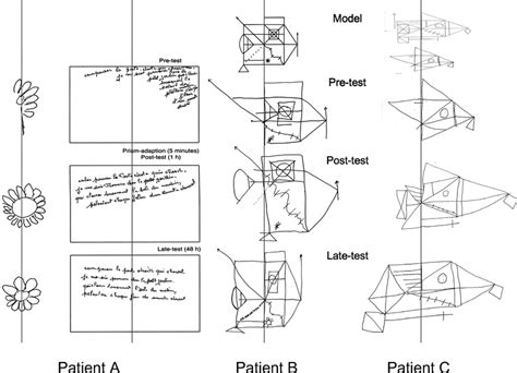 4 Left Object Centered Neglect Spatial Dysgraphia And Download