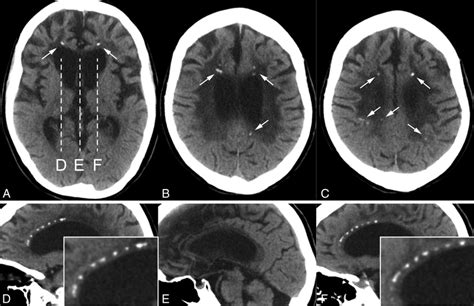 A C Case 1 Small Bilateral Calcifications In The Frontal And Parietal Download Scientific