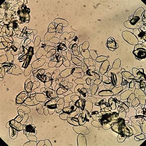 Cristales De Ácido Urico En Sedimento Urinario Sedimento Acidourico