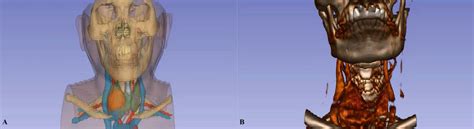 Mixed Reality Assisted Radical Endoscopic Thyroidectomy