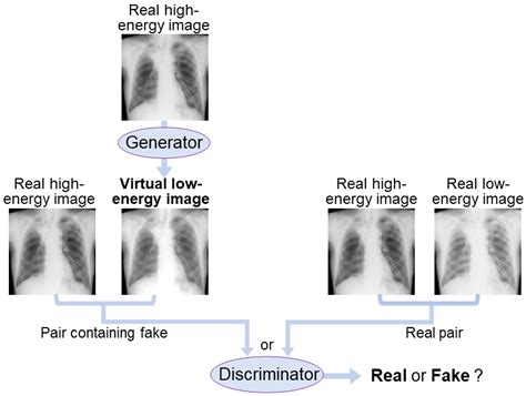 Development Of Artificial Intelligence Based Dual Energy Subtraction For Chest Radiography