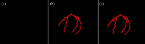 vessel segmentation results after 50 iterations level set evolution