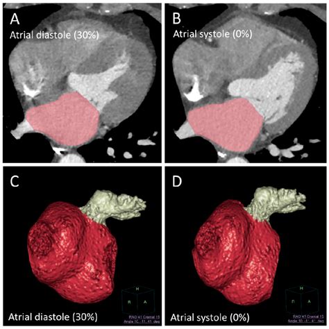 Automatic Left Atrial Segmentation Red As Proposed By Wolf Et Al Download Scientific Diagram