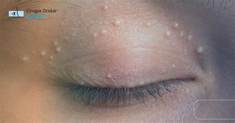 Granitos En El Párpado Causas Y Tratamiento