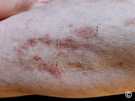 Schamberg Disease
