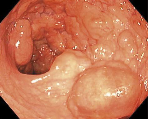 Pneumatosis Cystoides Intestinalis A Rare Cause Of Gastrointestinal Hemorrhage