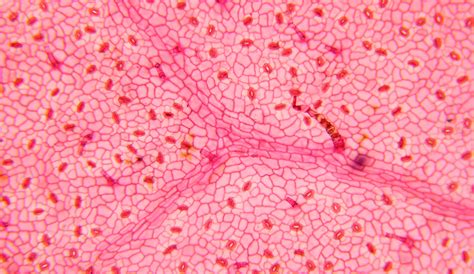 Normocytic Normochromic Anemia