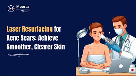 Laser Resurfacing For Acne Scars Achieve Smoother Clearer Skin