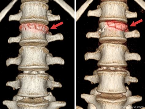 Medmovie Com L Vertebral Body Compression Fracture And My Xxx Hot Girl
