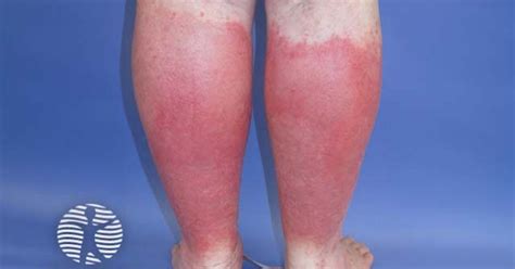 Acute Lipodermatosclerosis Image