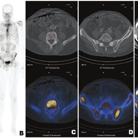 Gallium Scan Taken Before Chemotherapy Treatment In A Patient With