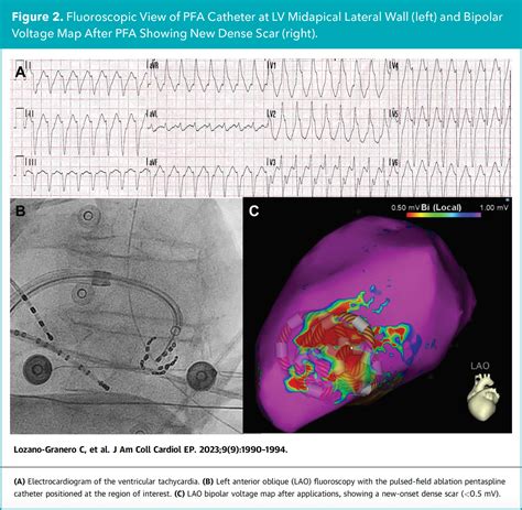 Focus On Ep The Next Frontier Of Pulsed Field Ablation Ventricular Arrhythmias American