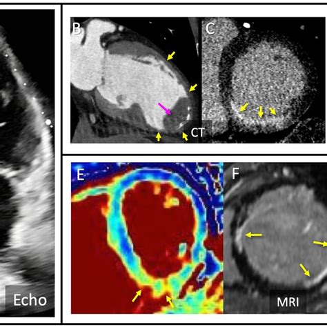 Imaging Techniques For Intra Procedural Guidance Of Vt Ablation A