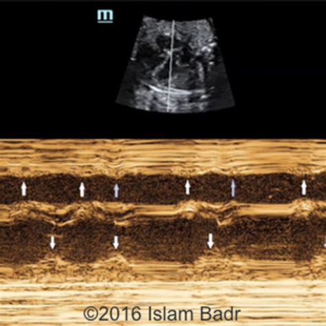 📃 Multiple Blocked Premature Atrial Contractions Resulting In Fetal
