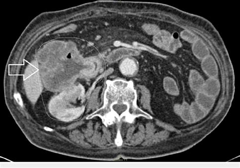 Computed Tomography Ct Scan Of Abdomenpelvis Axial View Showing A