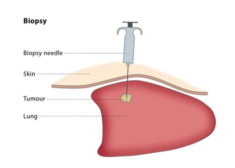 Biopsy Dr Ravjit Sagoo