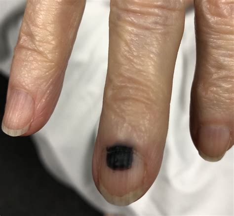 Sinal De Hutchinson Zoster Retoedu